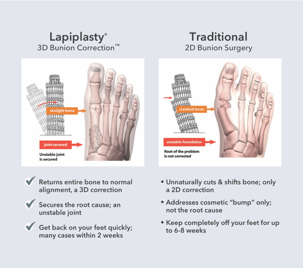 Lapiplasty Bunion Surgery in Waco, TX | Waco Podiatry